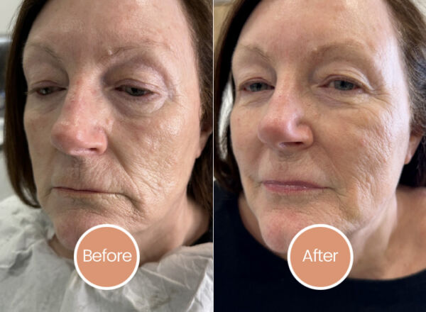 Skin Booster Injections Redermalization Profhilo And Sunekos